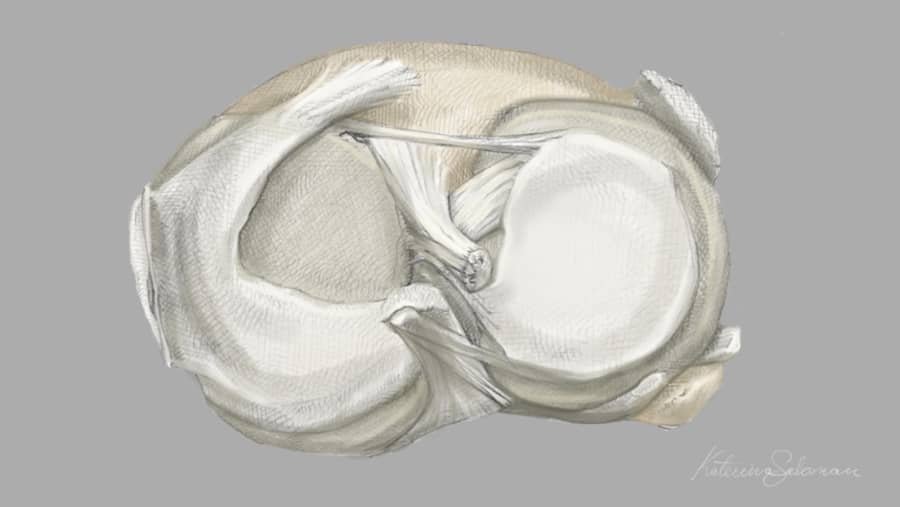 What is Discoid Meniscus?