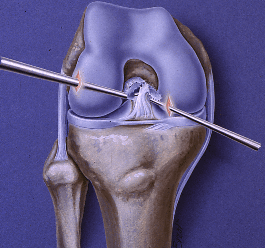 ACL Repair vs. Reconstruction: Here’s the Latest