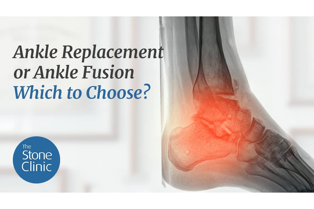 Ankle Replacement or Ankle Fusion. Which to Choose? (Video Blog)