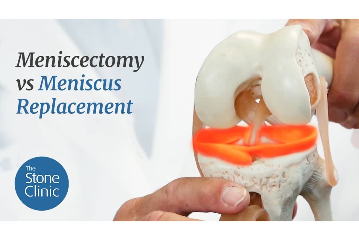 Meniscectomy vs Meniscus Replacement (Video Blog)