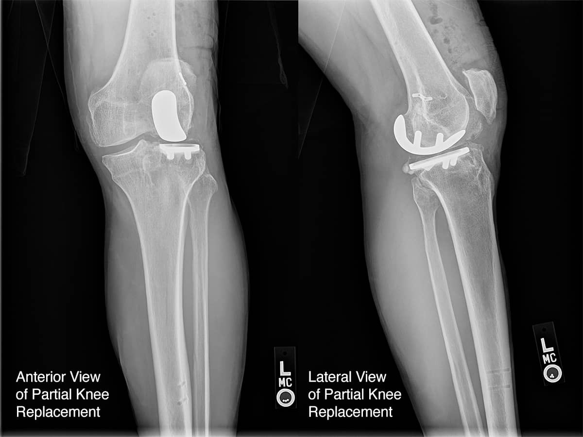 Partial Knee Replacement