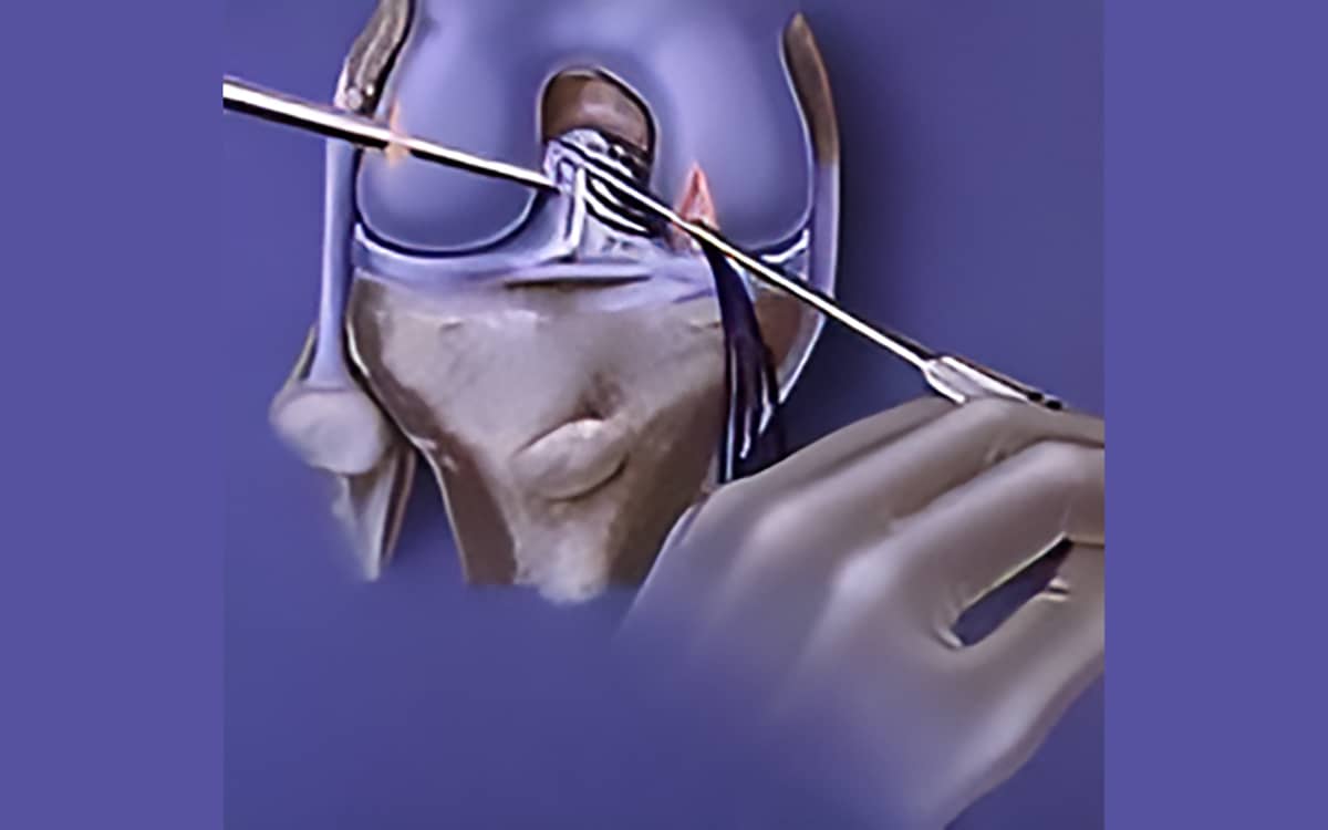 ACL Repair Revisited