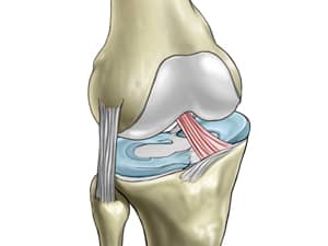 An Alternative to Knee Replacement: The BioKnee
