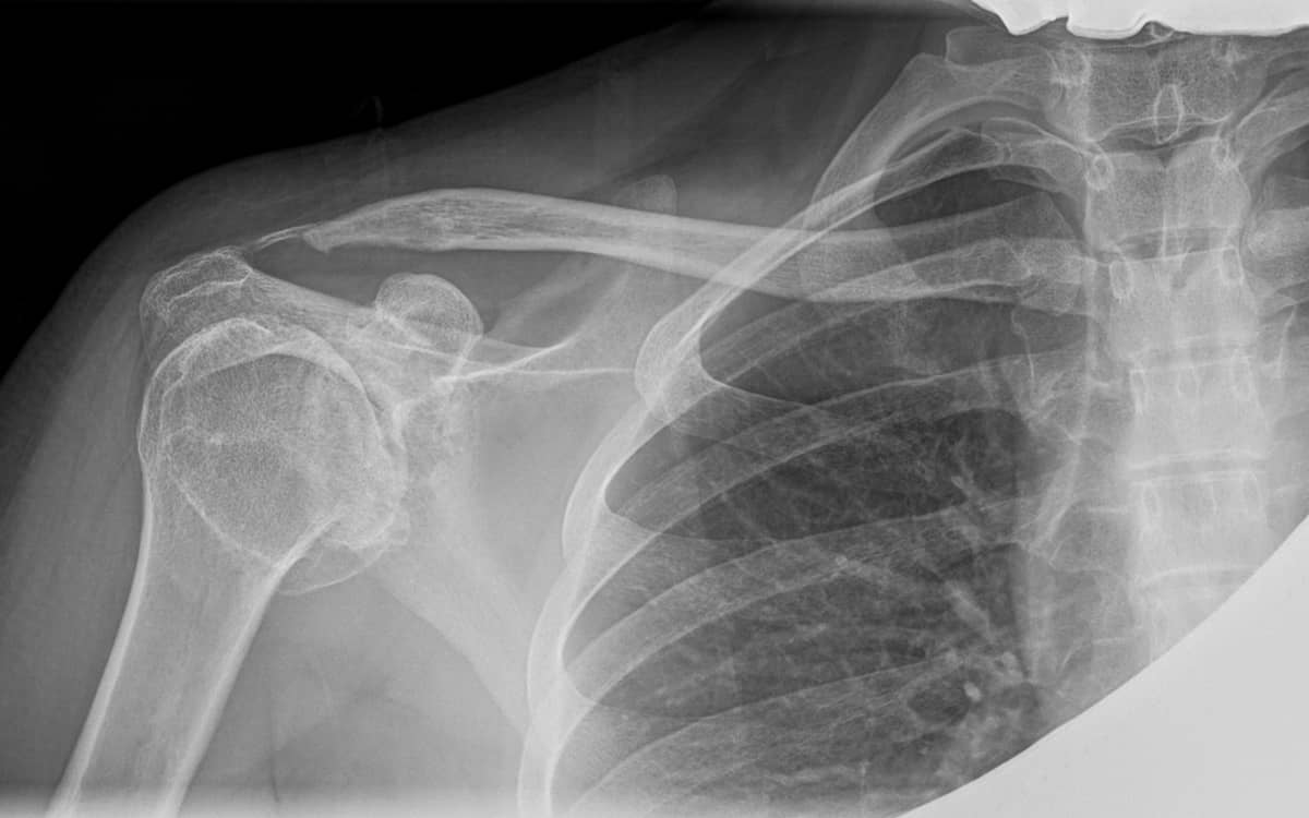 Shoulder Arthritis
