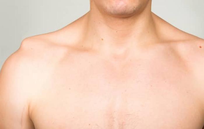 Back Bones Stick Out : Sternum Popping Treatment Pain Chest Pain And ...