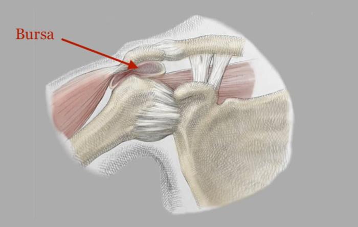 Shoulder Bursitis/Impingement | Treatment & Recovery Time