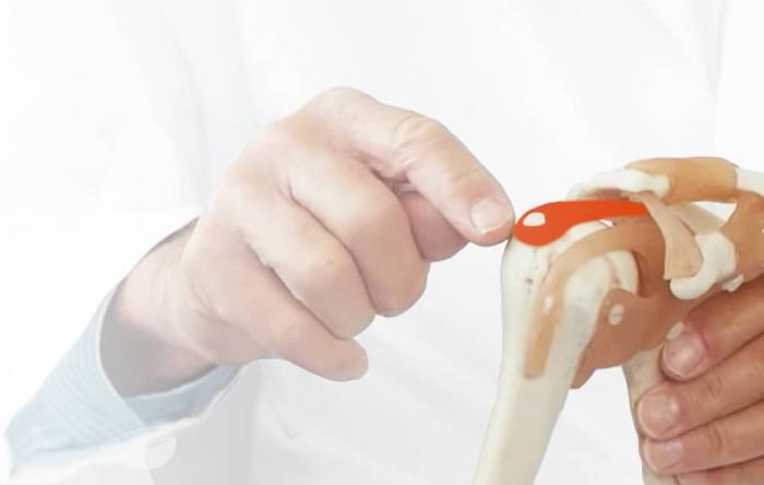 Rotator Cuff Repair | Rehab Protocol & Recovery Time Frame