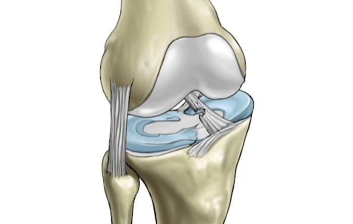 ACL Reconstruction & Meniscus Repair Surgery Rehab Protocol