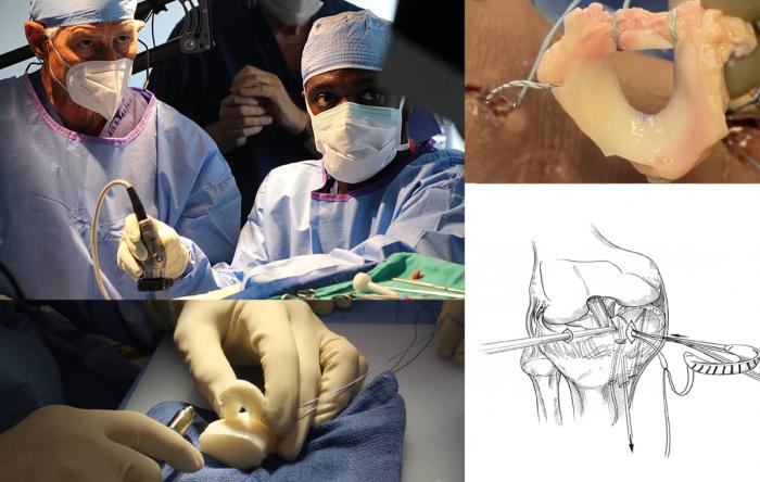 The Meniscus Transplant Center | Meniscus Replacement for Arthritis