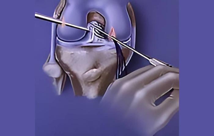 ACL Reconstruction & Meniscus Repair Surgery Rehab Protocol