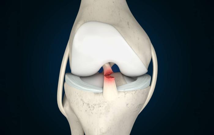 ACL Reconstruction & Meniscus Repair Surgery Rehab Protocol