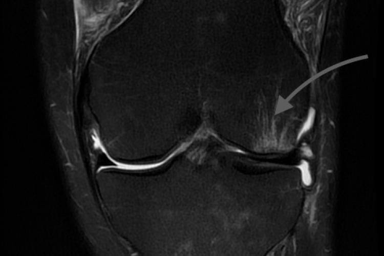 How To Fix a Dislocated Knee Cap | Symptoms & Treatment