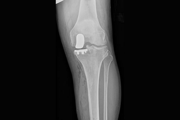 How To Fix a Dislocated Knee Cap | Symptoms, Diagnosis, Treatment